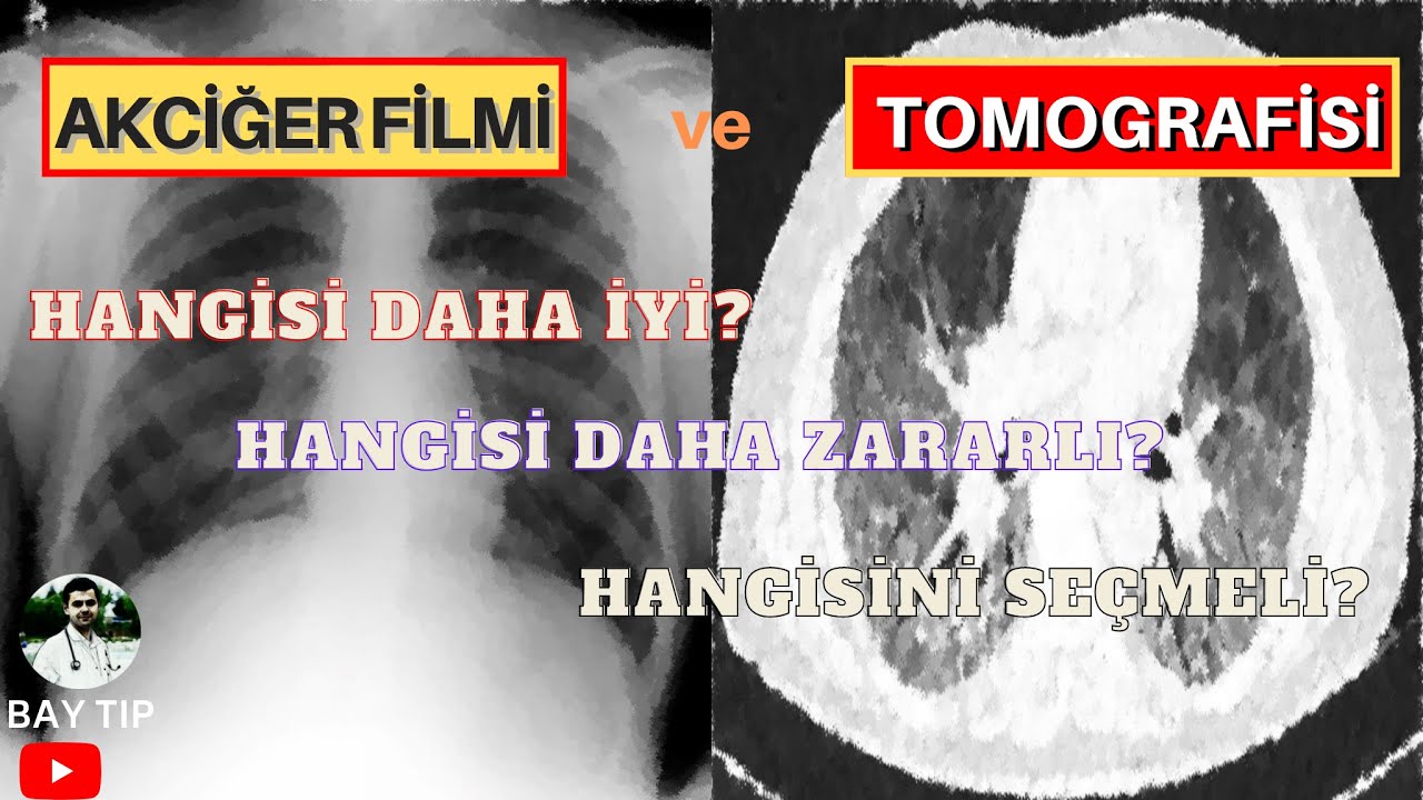 🥇 Akciğer filmi nerede çekilir? 5 Hayati Adım!