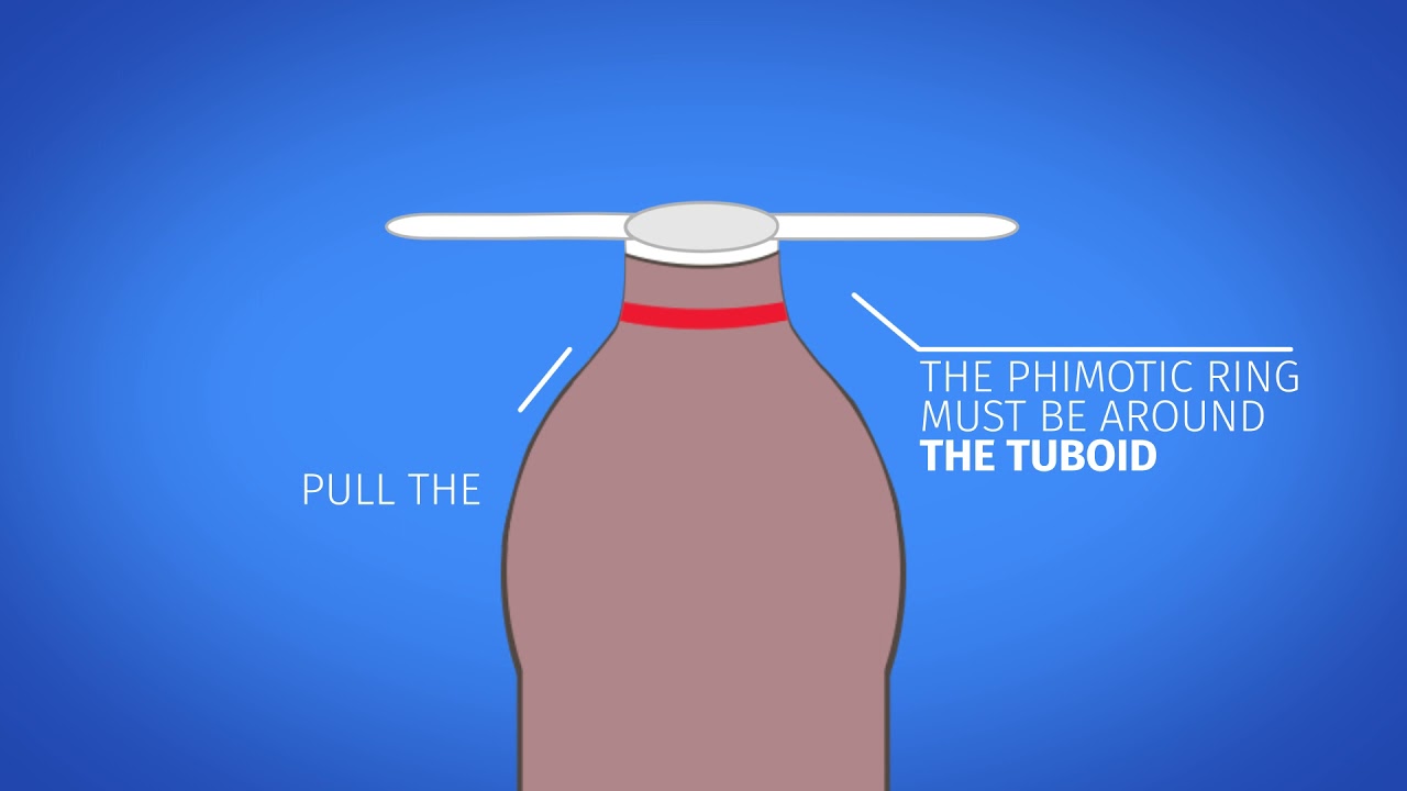 🥇 Fimosis: 5 datos clave que debes conocer urgentemente